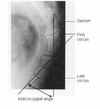 Kim: Clinical differences between types of coccygodynia